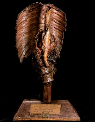 Museo di Anatomia Patologica - Reperti - Aneurisma sacciforme dell ...